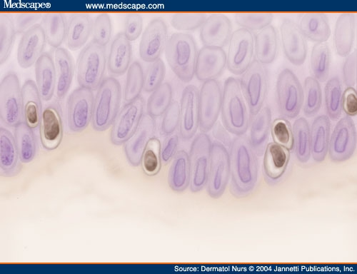 Hyperpigmentation: An Overview of the Common Afflictions