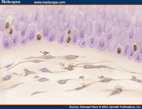 Hyperpigmentation: An Overview of the Common Afflictions