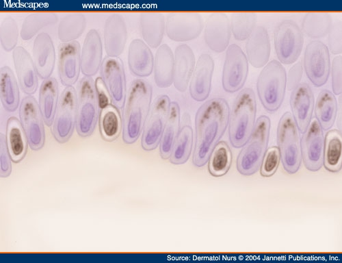 Hyperpigmentation: An Overview of the Common Afflictions
