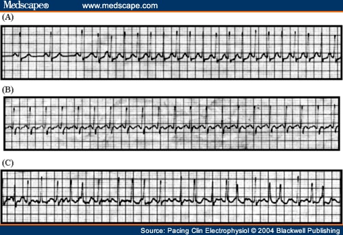Paroxysmal Atrial Fibrillation