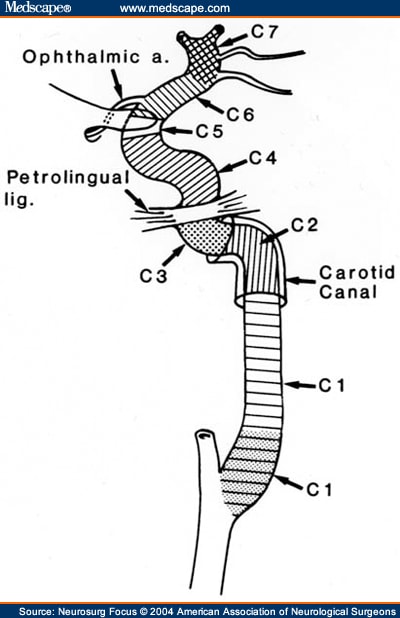 Aneurysms of the Petrous Internal Carotid Artery