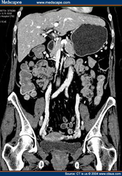 DVT or Normal Collaterals?