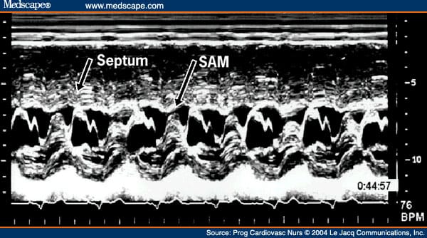 Obstructive Hypertrophic Cardiomyopathy