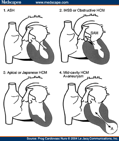 Obstructive Hypertrophic Cardiomyopathy