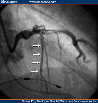Obstructive Hypertrophic Cardiomyopathy