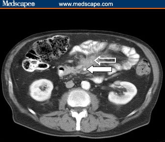 83-Year-Old Man With Abdominal Pain, Nausea, and Weight Loss - Page 2