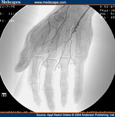 Mechanic with Necrotic Distal Third Digit