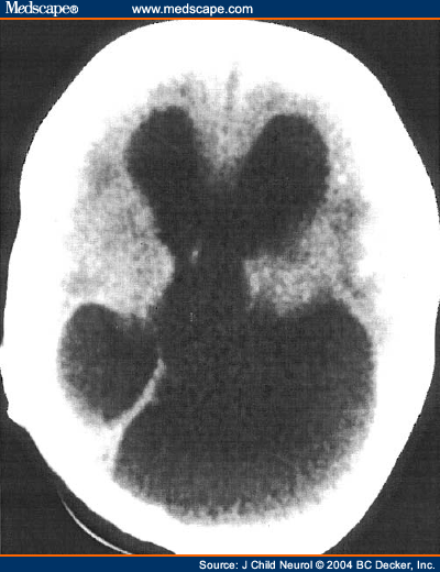 Influence of Neuroendoscopic Third Ventriculostomy - Page 4
