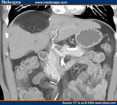 Biloma or Infarction?
