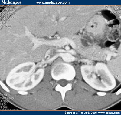Assessing Renal Disease