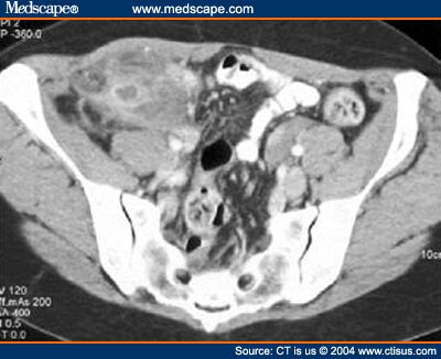 Is This Appendicitis?