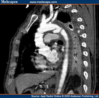 Abnormal Chest x-Ray After Motorcycle Accident