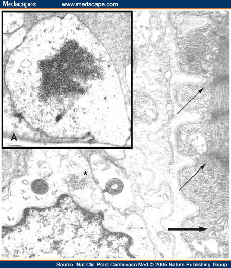 Reversible Cardiomyopathy Caused By Administration of Interferon - Page 2