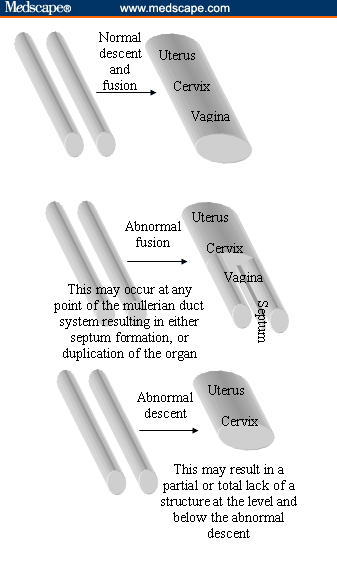Uterine Anomalies