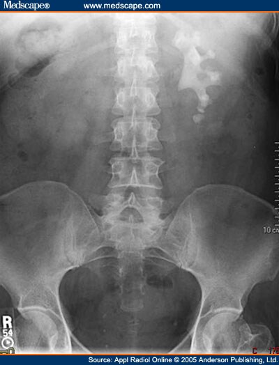 Flank Pain and Recurrent Fevers