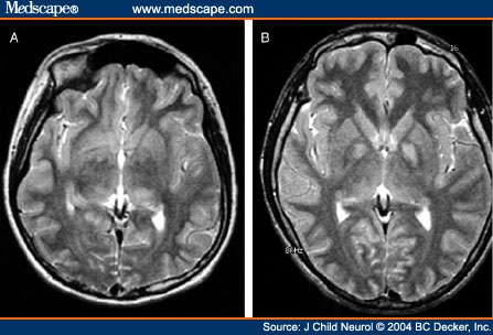 T2-Weighted Hyperintensities (Unidentified Bright Objects) in - Page 3