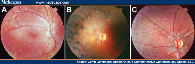 The Genetics of Hereditary Retinopathies and Optic Neuropathies - Page 5