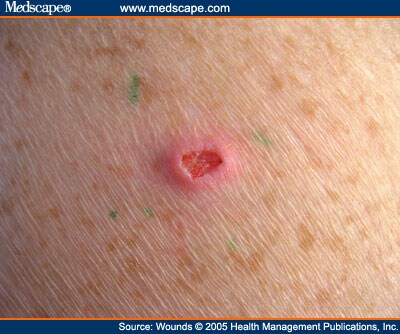 Crusted Lesions At Kirksville College Of Osteopathic