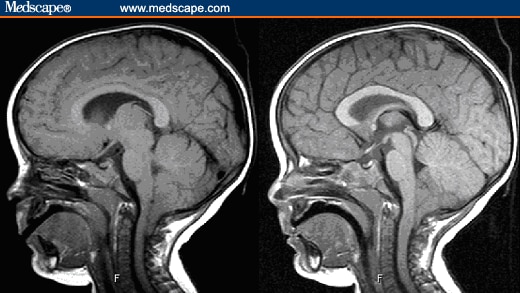 Respiratory Failure in a 22-Month-Old Boy - Page 4