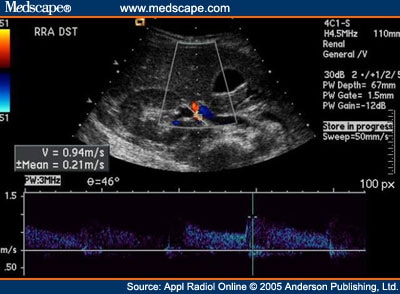 Refractory Hypertension