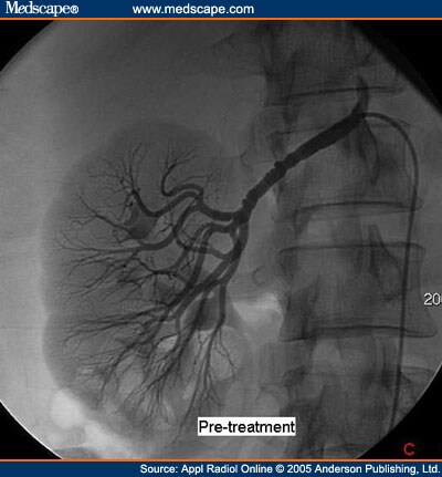 Refractory Hypertension