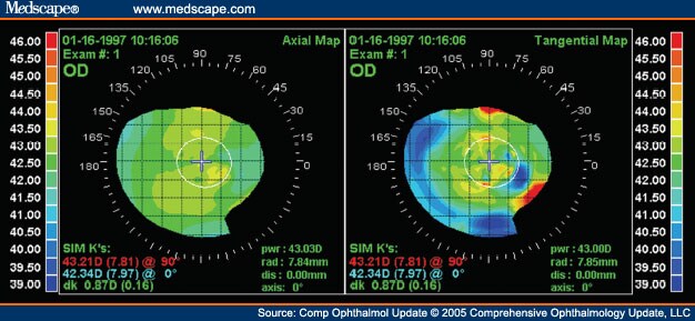 Corneal Topography and its Integration into Refractive Surgery - Page 3