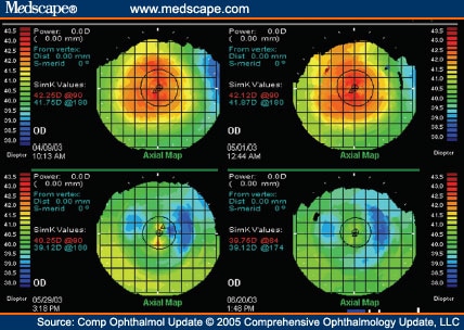 Corneal Topography and its Integration into Refractive Surgery - Page 3