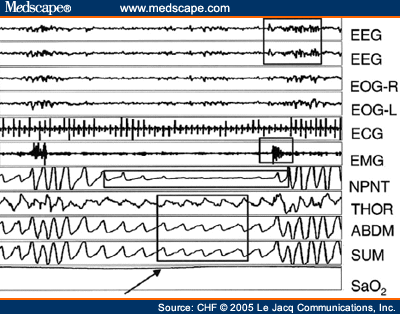 Implantable Pacing Devices and Sleep Apnea: Implications - Page 3