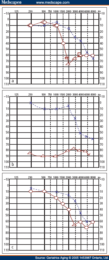 Sudden Deafness, Part 1: Diagnosis and Treatment