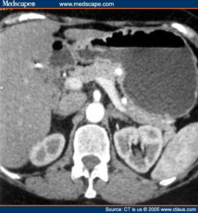 Virtual Endoscopy: New Standard of Care?