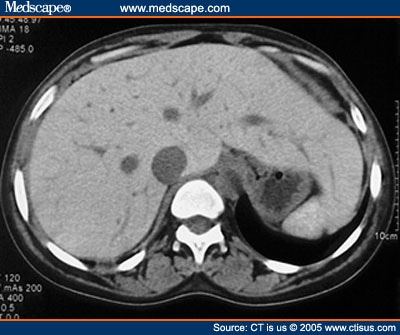 Hemochromatosis or Renal Failure?