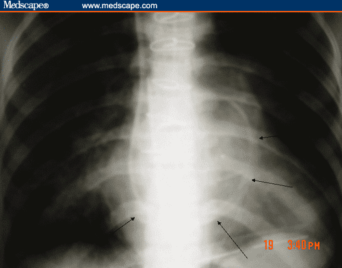 The 2-Bodied Continuous Cardiac Output Catheter - Page 2