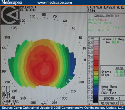 Contact Lens Fitting in the Refractive Surgery Patient - Page 4