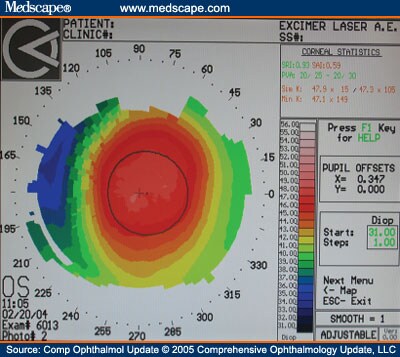 Contact Lens Fitting in the Refractive Surgery Patient - Page 4