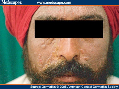 Eczema Herpeticum Complicating Parthenium Dermatitis - Page 2