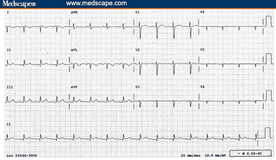 Dextrocardia or Reversed Limb Leads?