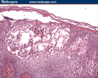 A Pustular Skin Rash in a Woman With 2 Weeks of Diarrhea - Page 2
