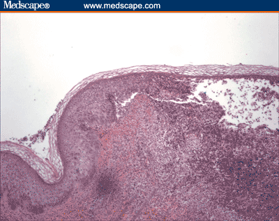 A Pustular Skin Rash in a Woman With 2 Weeks of Diarrhea - Page 2