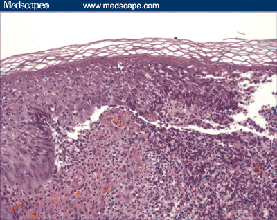 A Pustular Skin Rash in a Woman With 2 Weeks of Diarrhea - Page 2