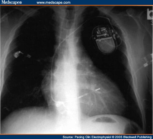 Implantable Hemodynamic Monitor for Symptomatic Heart Failure - Page 2
