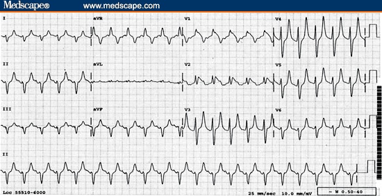 Anteroseptal Infarct?