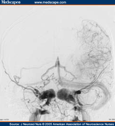 Carotid-Cavernous Sinus Fistula: A Case Study - Page 2