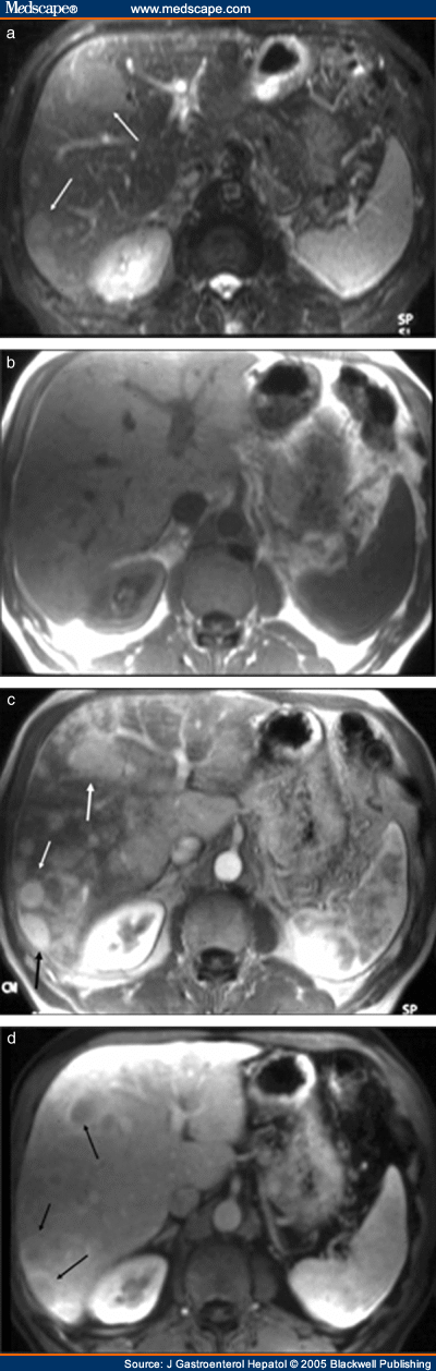 Focal Lesions in Normal Liver - Page 9