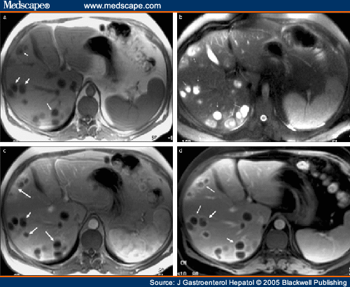 Focal Lesions in Normal Liver - Page 7