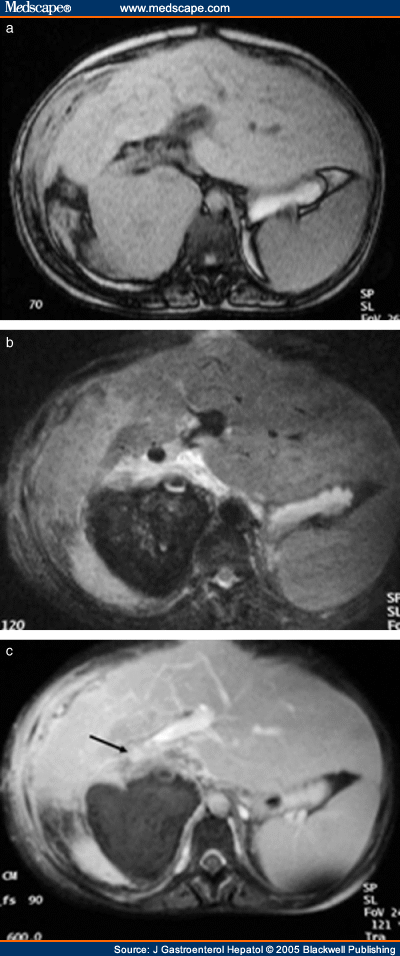Focal Lesions in Normal Liver - Page 7