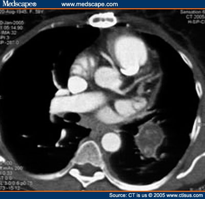 Characterize This Pulmonary Embolism