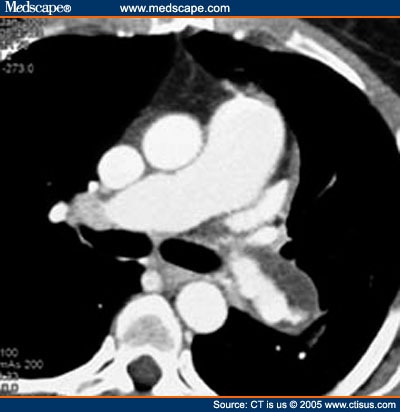 Characterize This Pulmonary Embolism