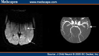 A Case Series of Multifactorial Ischemic Strokes in Children - Page 2