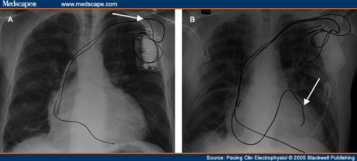 Robotic Epicardial Lv Lead Placement | semashow.com