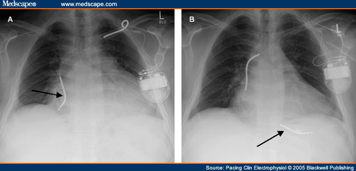 Complications of Implantable Cardioverter Defibrillator Therapy - Page 3